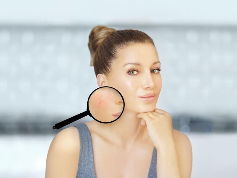 Elidel -voide ruusufinnin hoidossa - wellea.fi