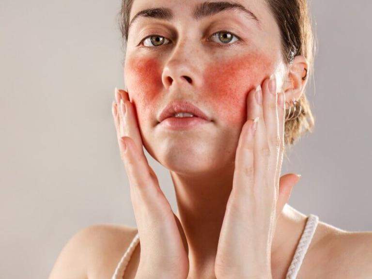 Soolantra -lääkevoide ja ruusufinni - wellea.fi