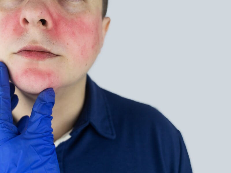 Elidel -voide ruusufinnin hoidossa - wellea.fi